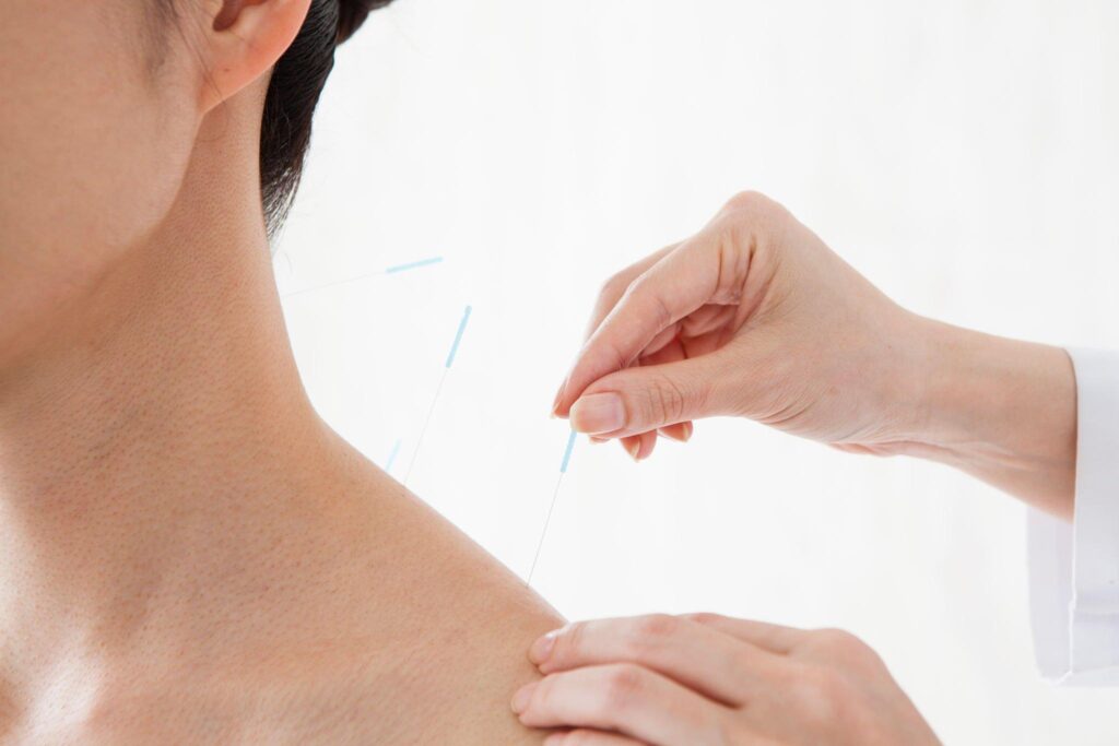 Acupuncture Treatment In Aylesbury | Acupuncture Treatment Clinic